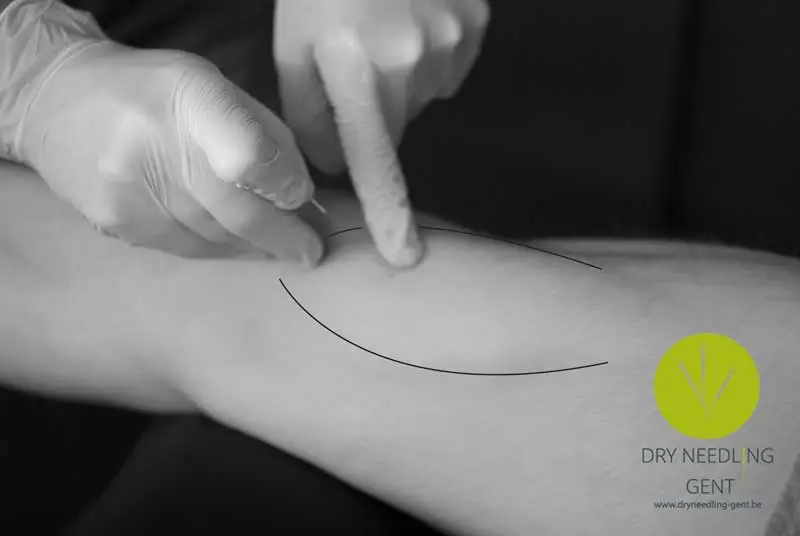 Dry Needling Therapie | Kinefysix